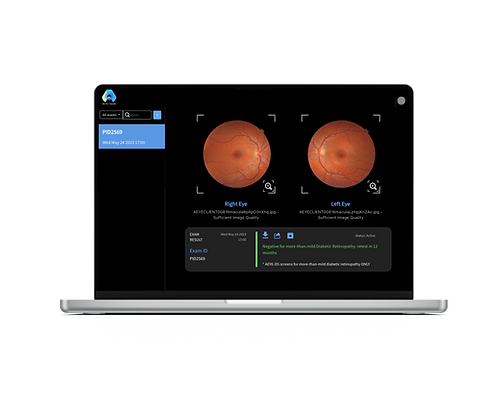 人工智能|全自动便携式AEYE-DS美国获批糖尿病视网膜病变(DR)筛查 | 百配健康-阅读越健康!