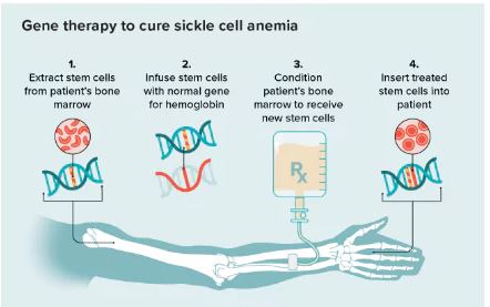 新药|Lyfgenia美国获批治疗12岁及以上患有血管闭塞危象(VOE)的镰状细胞贫血病(SCD) | 百配健康-阅读越健康!